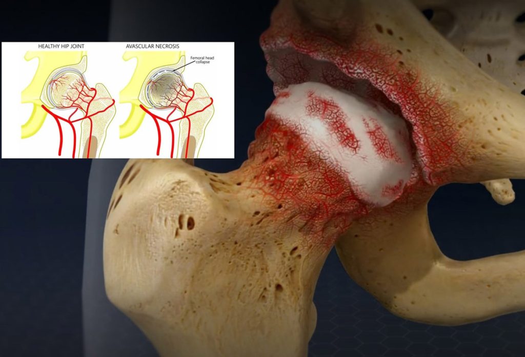 Understanding Avascular Necrosis (AVN) - Dr. Shyam
